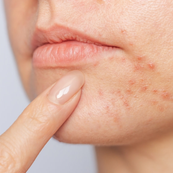 Treating perioral dermatitis | Swiss Derma Clinic